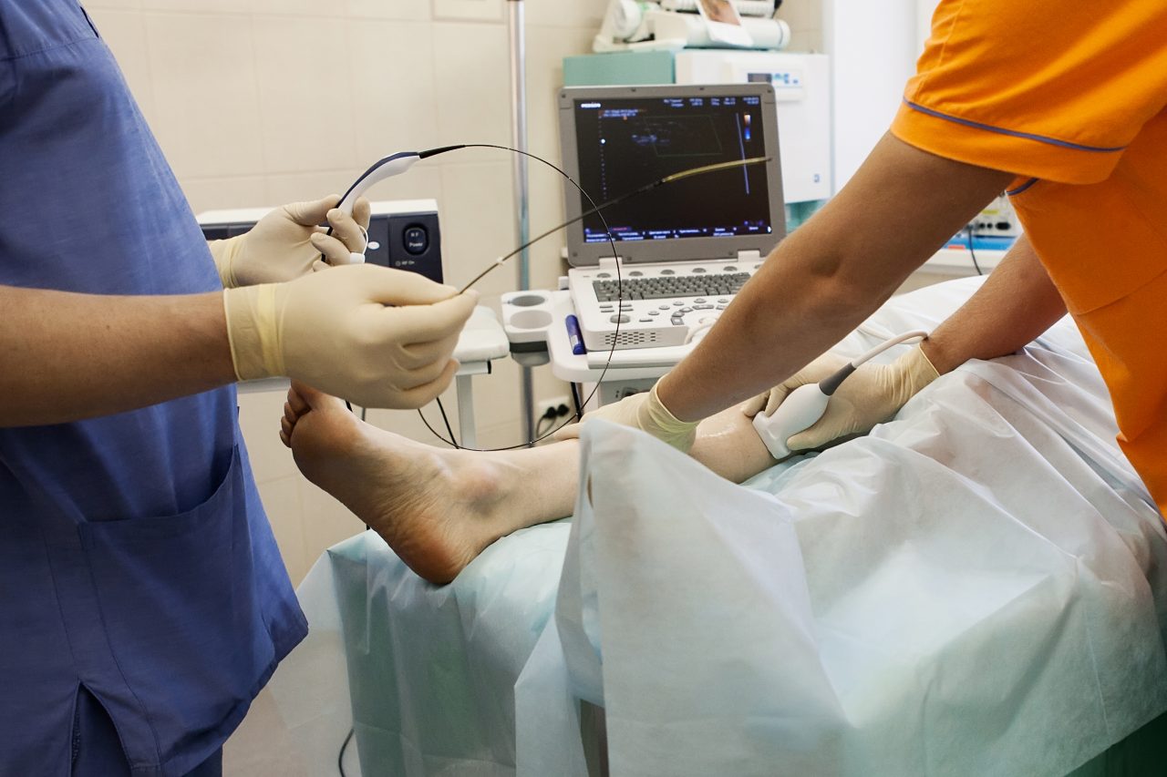 Radiofrequency Ablation Treatment - Why Consider For Varicose Veins?