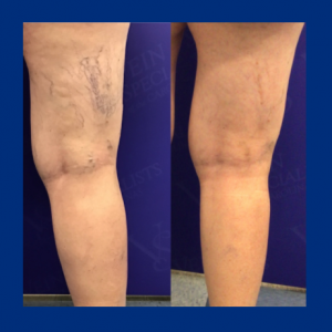 Sclerotherapy - Spider Vein Treatment - Vein Specialists of the Carolinas