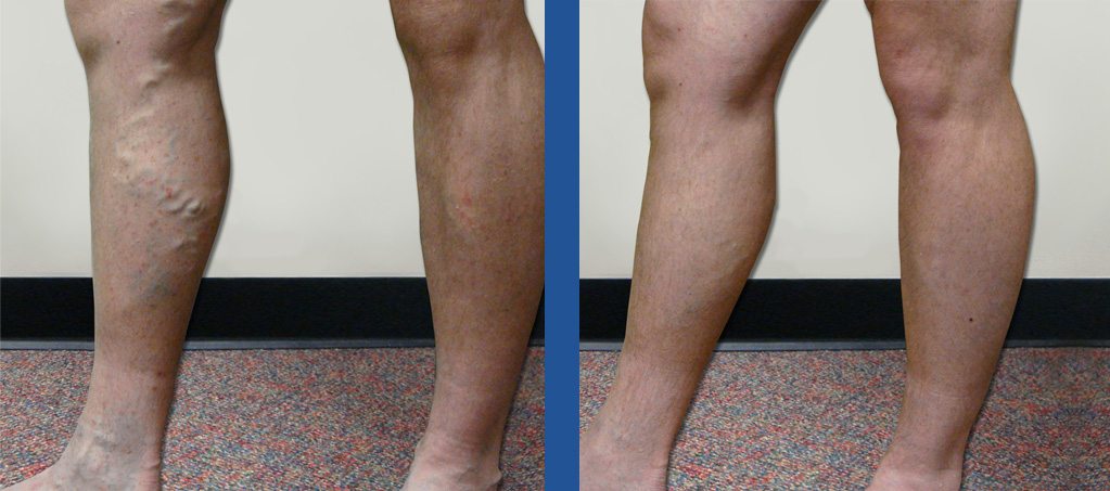 Vein Treatment Before and After Photos | Charlotte