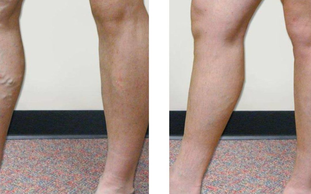 Vein Screening Is Important For Detection & Treatment of Vein Disorders