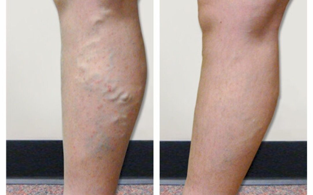 Non-Surgical Vein Treatments - Vein Specialists of the Carolinas
