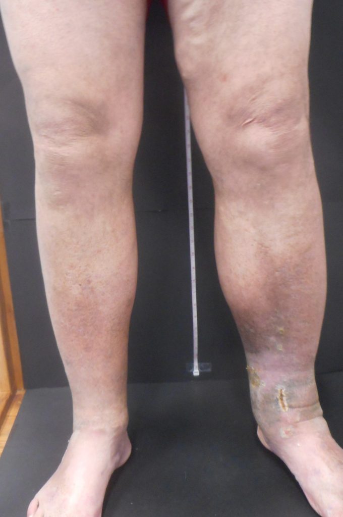 Do You Have Unexplained Swelling In Your Left Leg What Does It Mean 